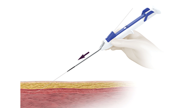 FemoSeal™ Vascular Closure System