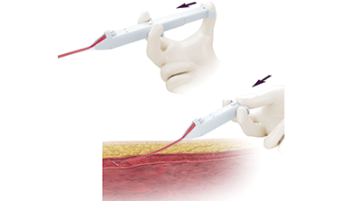 FemoSeal™ Vascular Closure System