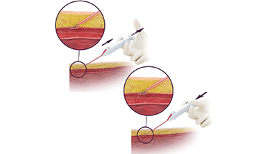 FemoSeal™ Vascular Closure System