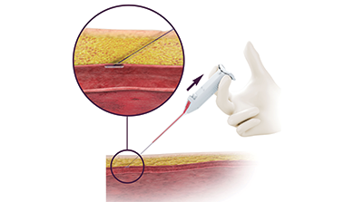 FemoSeal™ Vascular Closure System