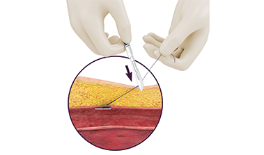 FemoSeal™ Vascular Closure System