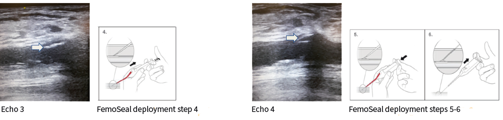 Case report with FemoSeal performed by Dr. Víctor González Martínez